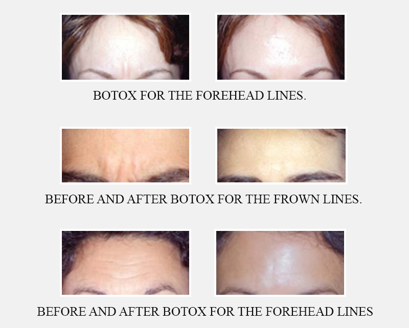Botox ( Botulinum Toxin ) | Dr Dany Touma Beirut Lebanon